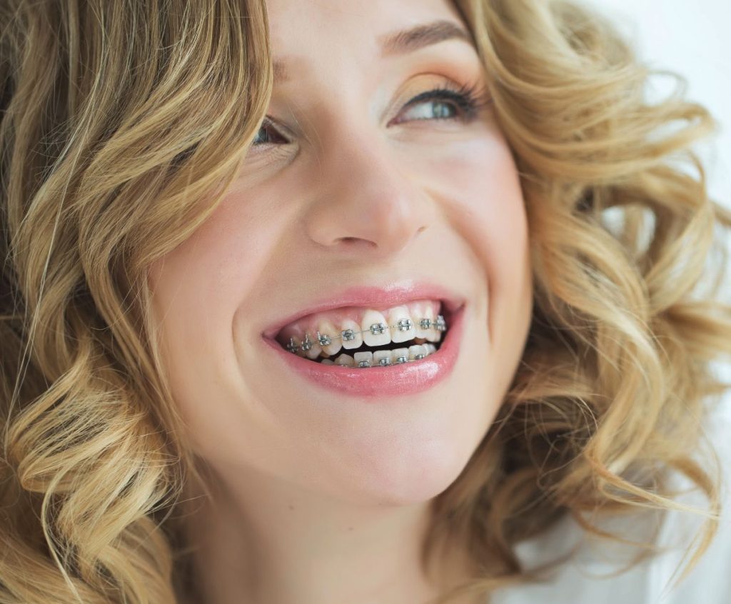 Types of Orthodontic Appliances/Braces - Los Angeles, CA - Orthodontic ...